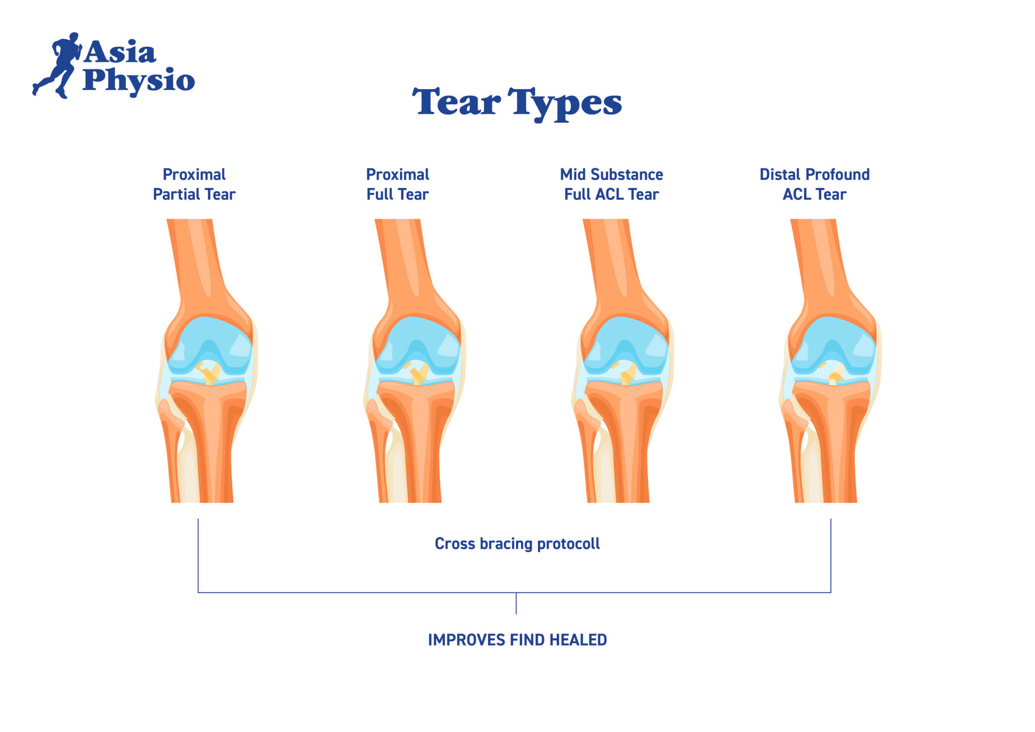 The Skiing ACL – Singapore Physio